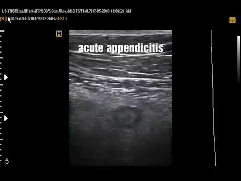 Acute appendicitis sonography with narration