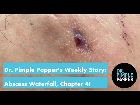 Dr. Pimple Popper Empties Waterfall Cyst In New Youtube Video