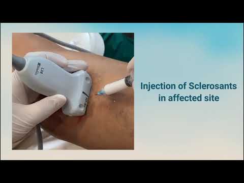 Sclerotherapy for Venous Malformation