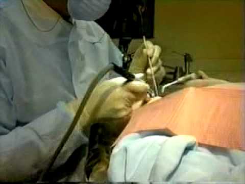 Preparation of Quadrant Fillings