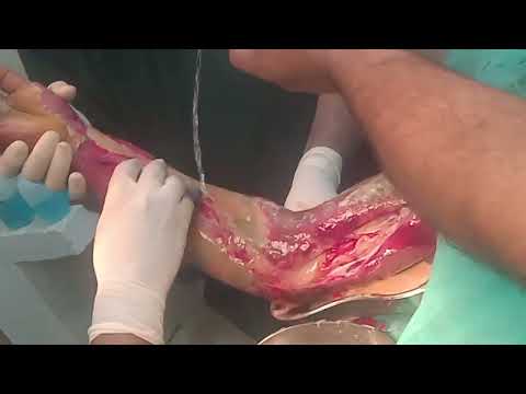 compartment synonym  due to tight band to fracture