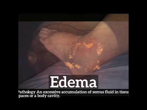How Does Edema Look? | How to Say Edema in English? | What is Edema?