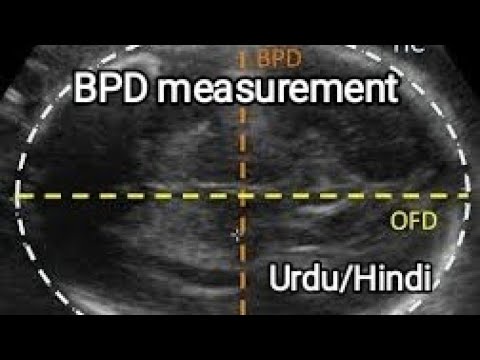 Biparietal Diameter measurement on ultrasound, BPD measure krna Ka Tariqa