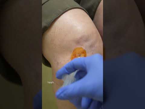 What to Expect from a Cortisone Injection for Knee Pain | Step-by-Step with Dr. Green