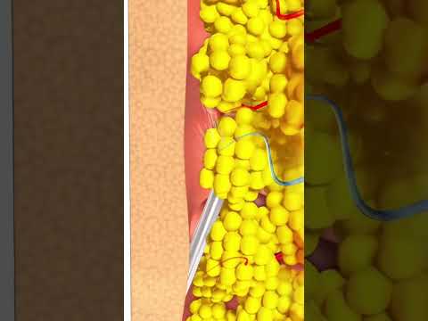 Say Goodbye to Stubborn Fat! Injection Lipolysis Explained by Dr. Hanan