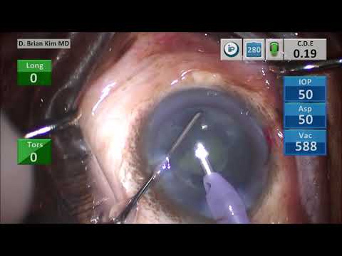 The Best Way To Do Cataract Surgery #42: White Cataract