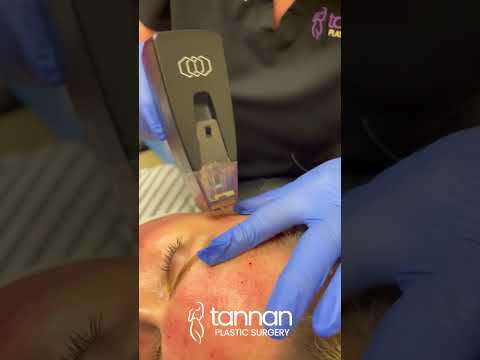 Meet Morpheus8 -- The latest and greatest in microneedling technology! #morpheus8 #inmode