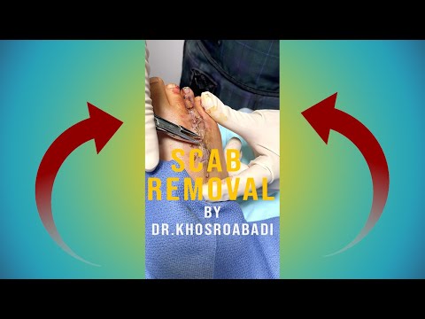 The Most Satisfying Scab Removal Experience