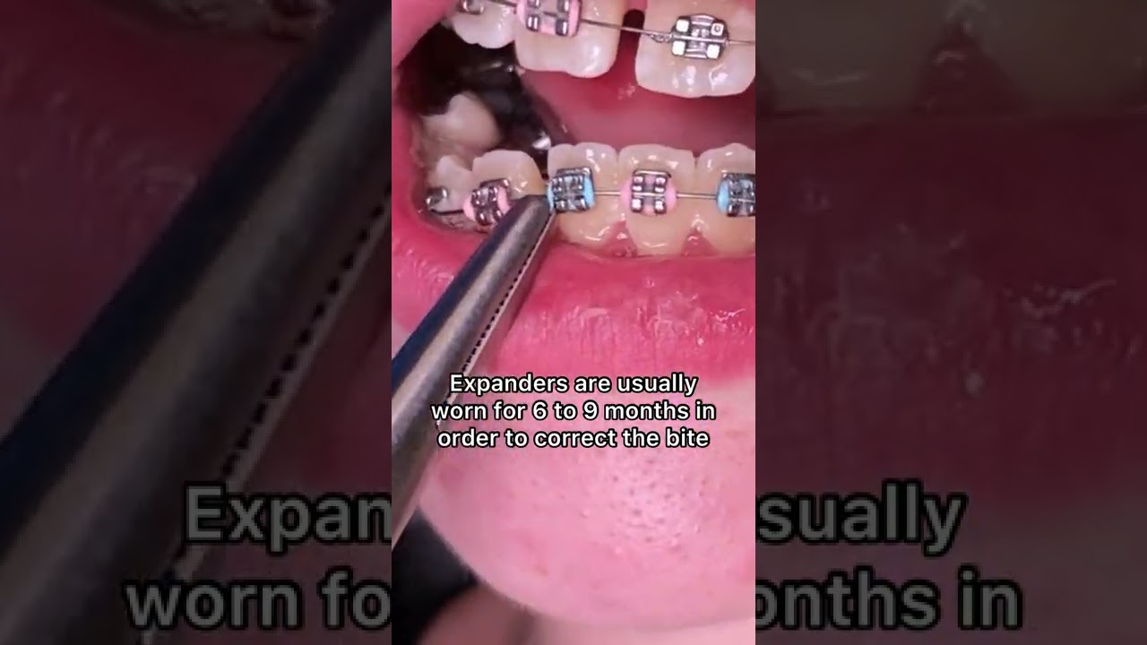 Orthodontic expanders 5 months on -11 year old px - RPE Upper & Lower - Tooth Time Family Dentistry