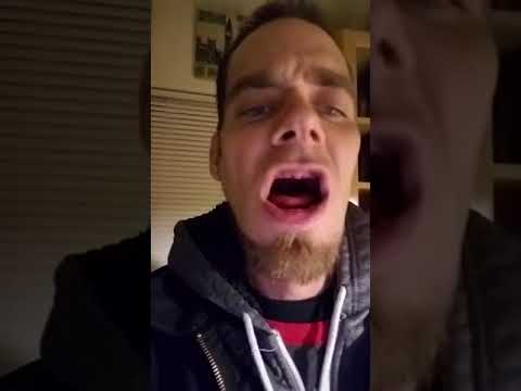 Redding California affordable dentures part 2.