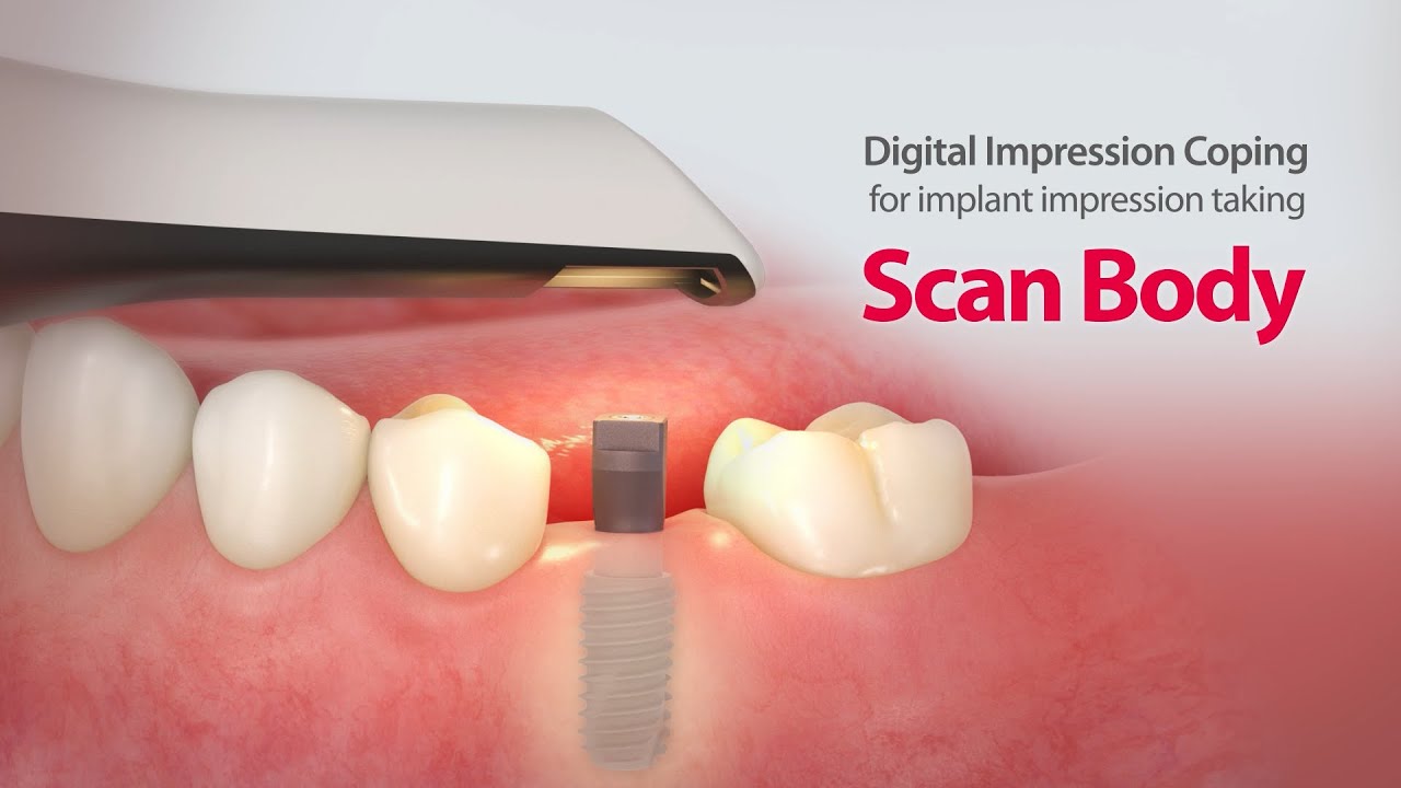 Digital Impression Coping for implant impression taking 