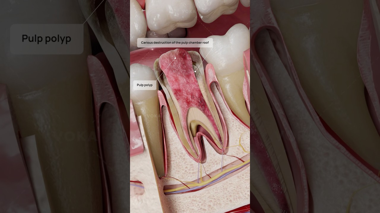 Pulp hyperplasia explained: a 3D visualization of irreversible pulpitis
