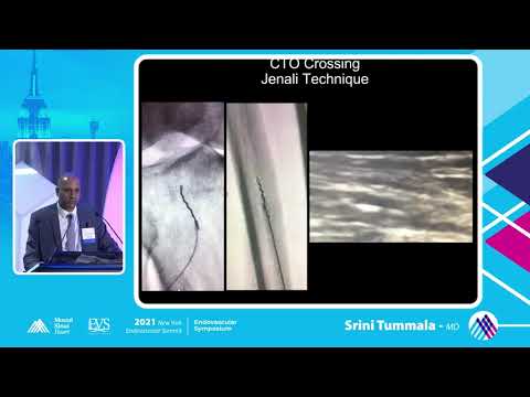 Algorithm for Femoral Popliteal CTO Crossing - Srini Tummala, MD