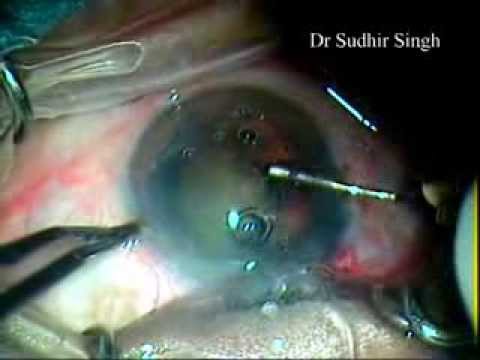 Stop N Chop Phaco in Nuclear Cataract By Dr Sudhir Singh