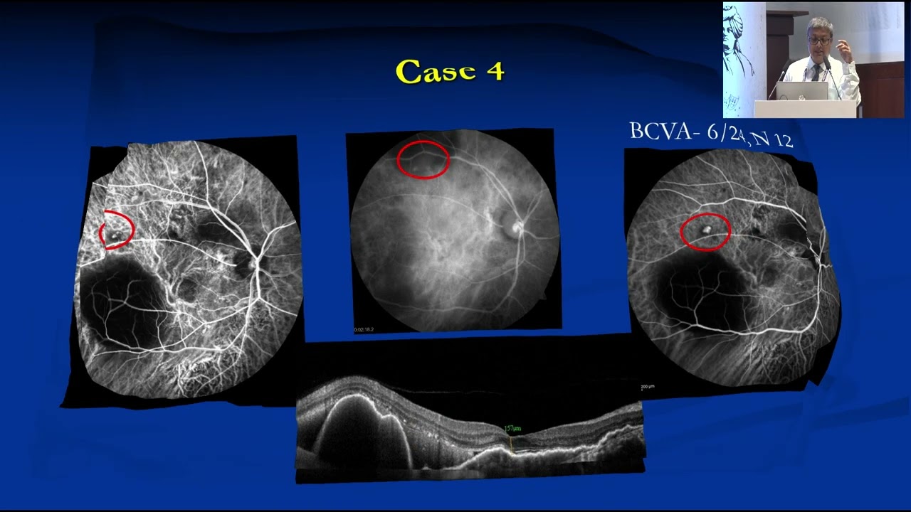 AIOC2024  GP49 Topic  Dr Krishnendu Nandi ICG angiography