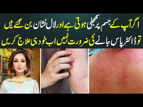 Jism Par Kharish Kyu hoti Hai | Psoriasis Treatment In Urdu - Chambal Ka Ilaj | Dr Sahar Chawla