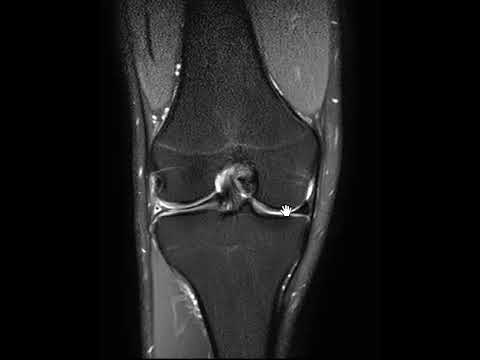 Bucket handle tear meniscus