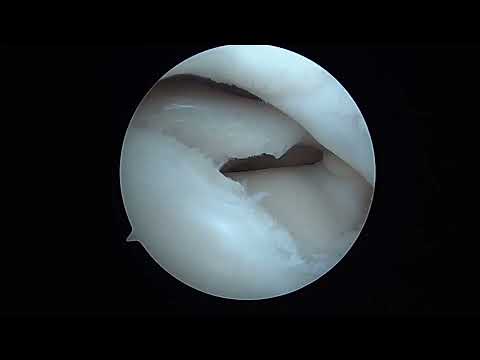 Comprehensive Arthroscopic Characterization of Discoid Meniscus Tears and Instability Using the PRiS