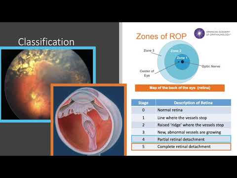 Retinopathy of Prematurity