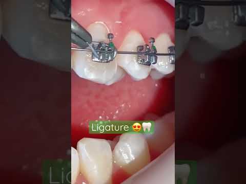 How Ligature Placed on the Bracket|Ligature Placed on Braces|Orthodontic Dentistry Treatments🦷