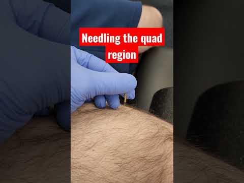 Dry Needling for muscle twitching | Physical Therapy