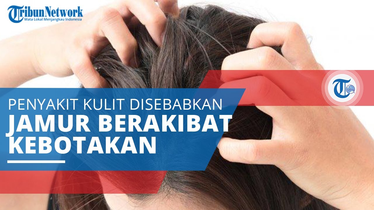 Tinea Capitis, Disebabkan Jamur Dermatofit yang Akibatkan Kulit Kepala ...