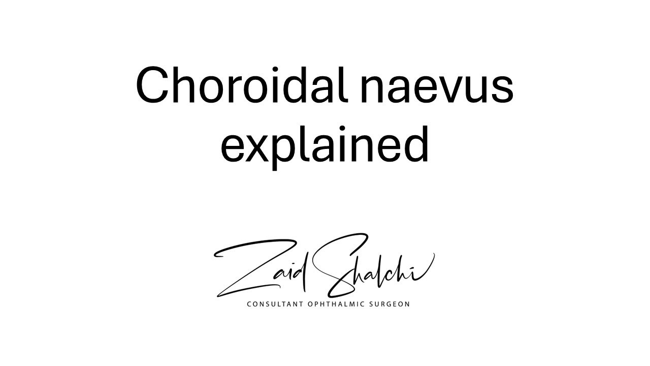 choroidal naevus explained