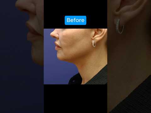 HUGE FACELIFT TRANSFORMATION