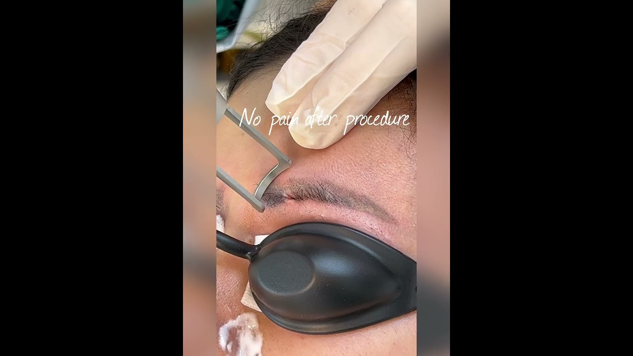 Laser  Tattoo Removal eyebrows #laserexperts #tattooremoval #lasertattooremovalspecialist