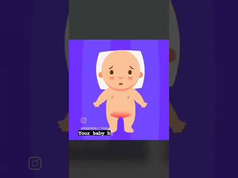 Diaper rash : Most common problem in children , occurs because of rubbing of moist skin and diaper