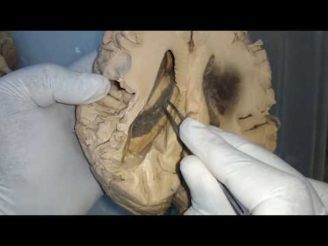 VENTRICLES OF BRAIN - Gross Anatomy