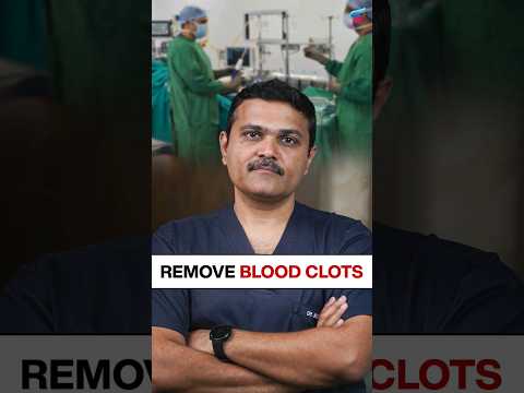 Remove BLOOD CLOTS without Surgery! #vascularsurgery #shortsvideo #thrombosis