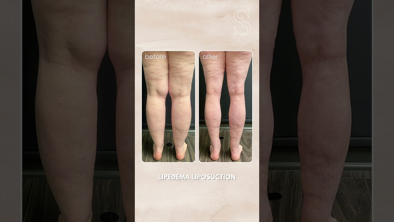 Lipedema Liposuction Before & After | Salameh Plastic Surgery Center