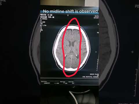 finding of Head | how to read CT Brain | Medical Imaging | Diagnosis of CT