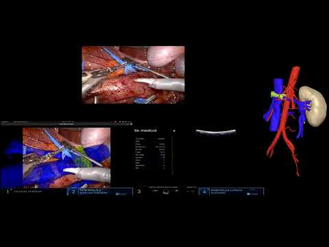 #332 First-in-man AI-assisted Augmented Reality Surgery Drs. Alex Mottrie & Jasper Hofman