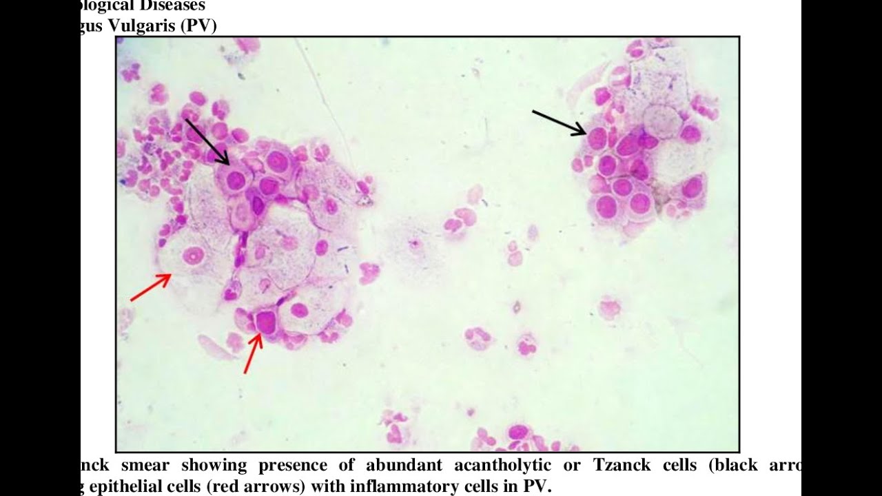 Tzanck smear, Tzanck test is a rapid, diagnostic tool in dermatology to identify blistering skin con