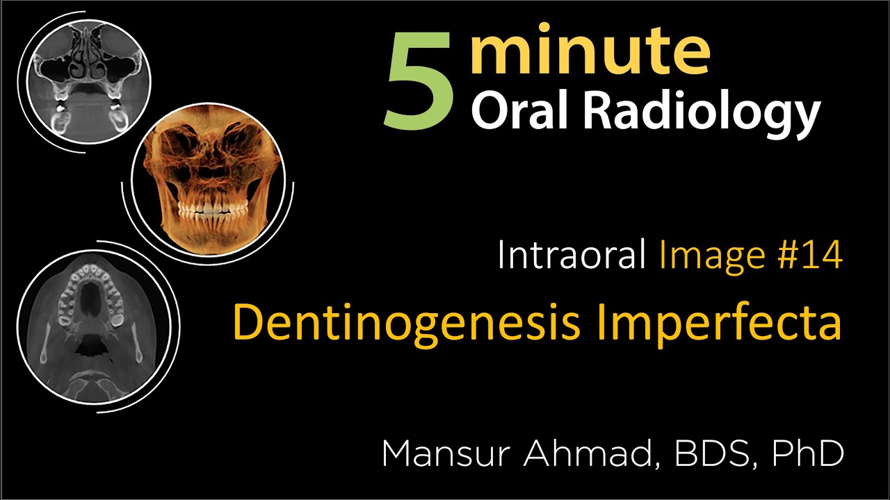Dentinogenesis Imperfecta: Intraoral Radiographic Interpretation