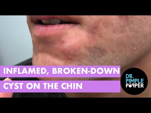 Dr. Pimple Popper Pops Inflamed Chin Cyst in New YouTube Video