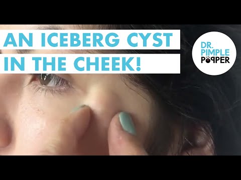 Dr. Pimple Popper Pops 'Iceberg' Eye Cyst In New Youtube Video