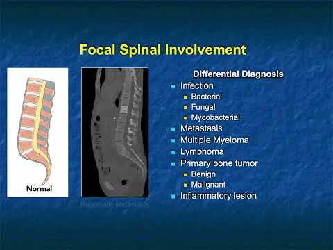 The Reformatted Sagittal Spine on Abdominal CT: Can a Single Image Make the Diagnosis?