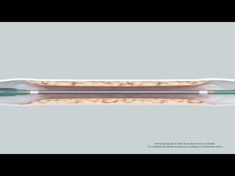 Catéter con Balón PTCA Chocolate XD® Implementación y Comparación