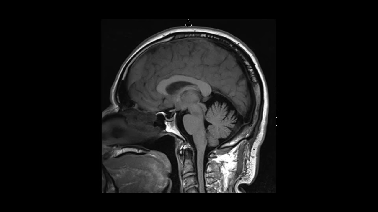 Acute-on-Chronic Bilateral Subdural Hematoma