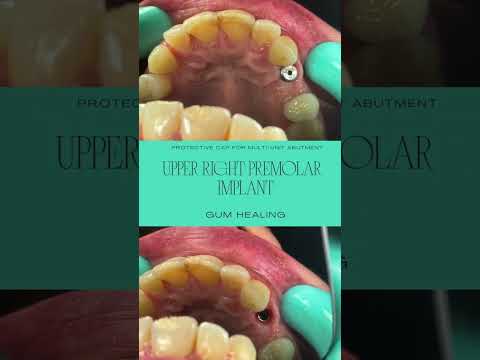 Description Dental Implant Procedure - Award Winning Two Phase Patient Education x / Zircon crown