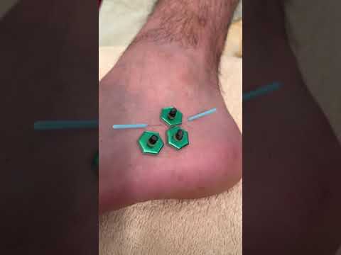 How to Use Acupuncture with Moxabustion for a Bone Bruise