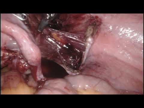 Dr. Anthony Brignoni, Davinci Robotic Hysterectomy, Lysis of adhesions