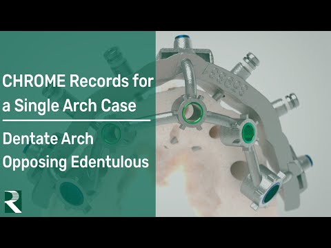 CHROME Records for single arch case: Dentate surgical arch, with opposing Edentulous