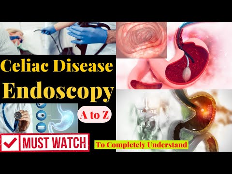 Celiac Disease Endoscopy | Endoscopy of Celiac Disease | Preparation | Celiac Disease | FBH