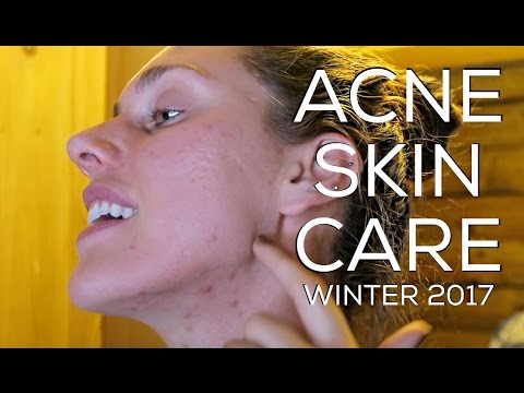 โ๏ธ My #Acne Skincare Routine For Winter! | Cassandra Bankson