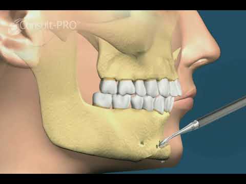 Chin Correction Surgery