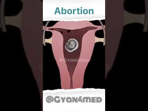 Abortion Animation